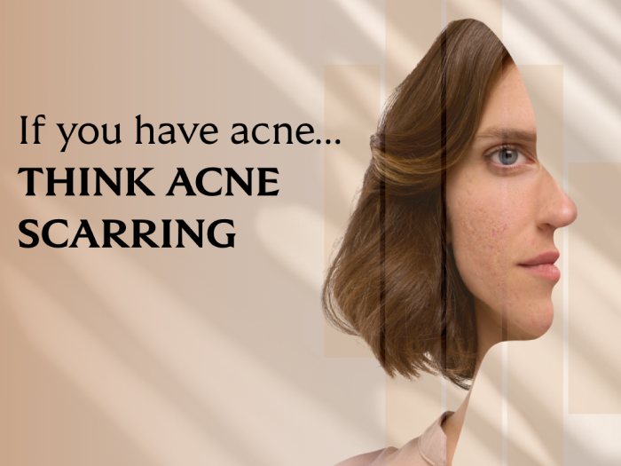 Acne Awareness Month 2024: understanding acne scarring | Galderma